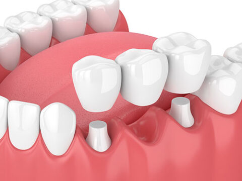 Crowns, Bridges And Veneers | Cornerstone Dental